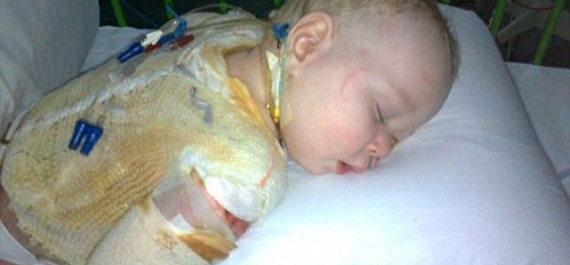 Terkena Tetesan Teh Panas, Nyawa Seorang Bayi Nyaris Melayang ...